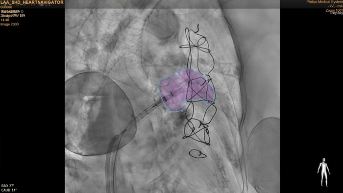 Left Atrial Appendage Occlusion (LAAO) | Philips Healthcare